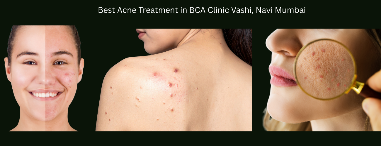 Anti-Acne Treatments